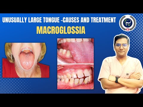Dr Rudra Mohan | Macroglossia - Enlarged Tongue - Understand Causes and Treatment Options