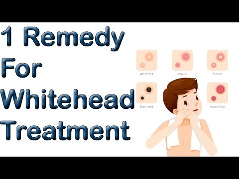 1 Remedy For Whitehead Treatment – Treat And Prevent Whitehead – Best ...