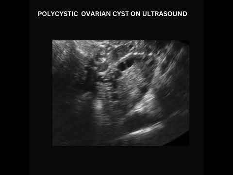 POLYCYSTIC OVARIAN SYNDROME #pelvicultrasound #pcos #infertility #shorts