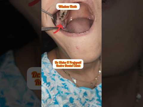 Akkal Dadh Kaise Nikalte Hai |Wisdom Teeth Removal #trending #shorts ##teeth #dr #youtubeshorts