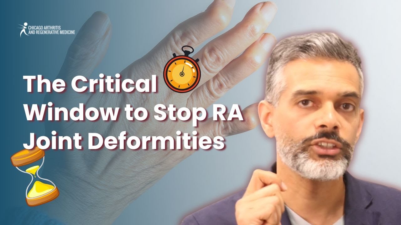 The Critical Window to Stop RA Joint Deformities - Chicago Arthritis ...