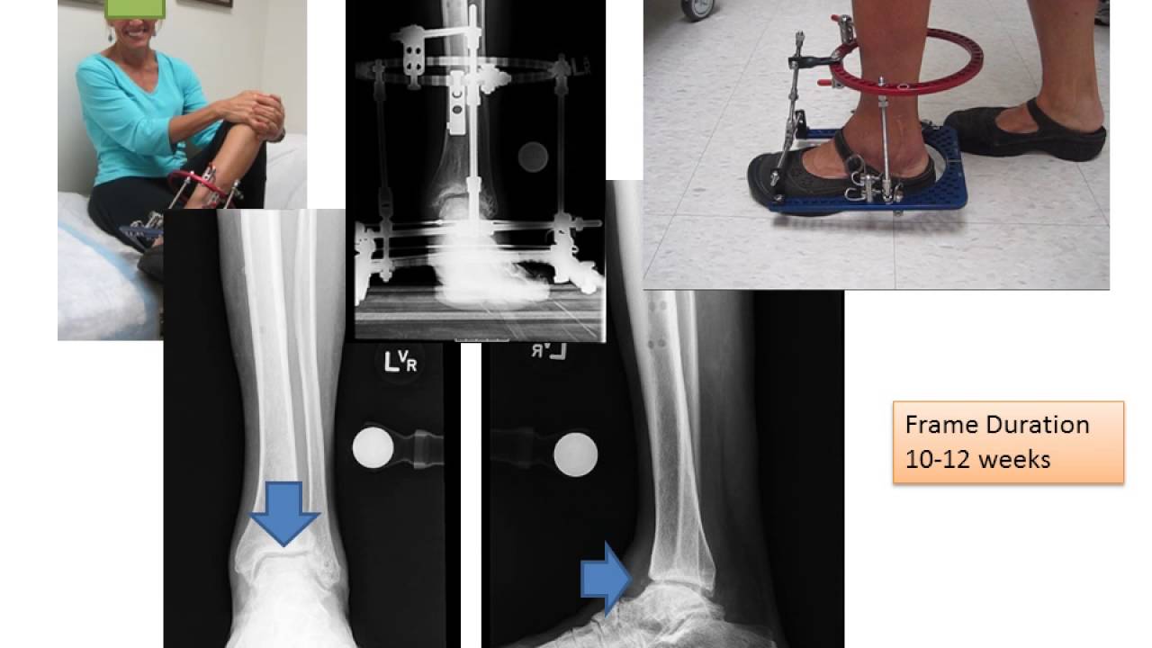 Ankle Distraction Surgery