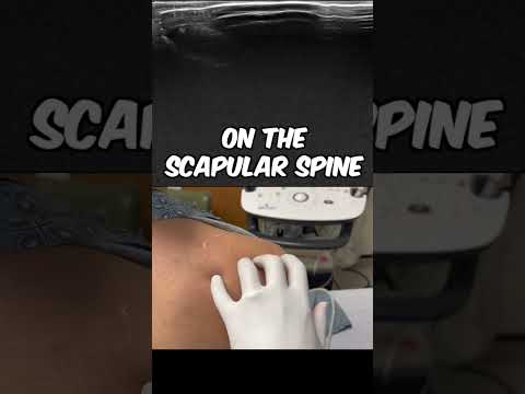 Find the suprascapular nerve location every time! #shoulder #nerveblock #suprascapular