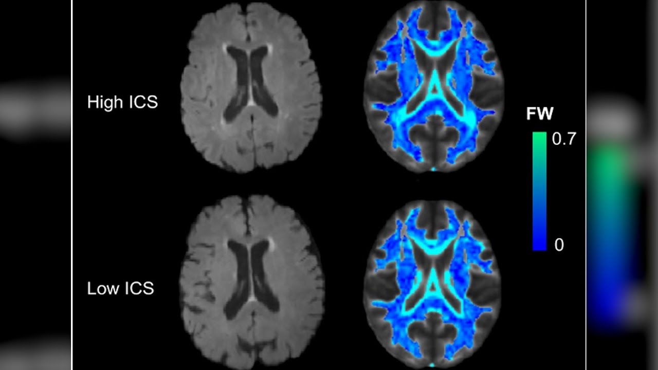 Stroke and Dementia Research: The Jason Hinman Lab