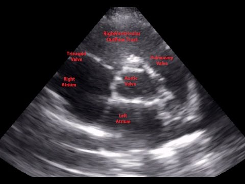 Parasternal Short Axis View Aortic Level - Loop