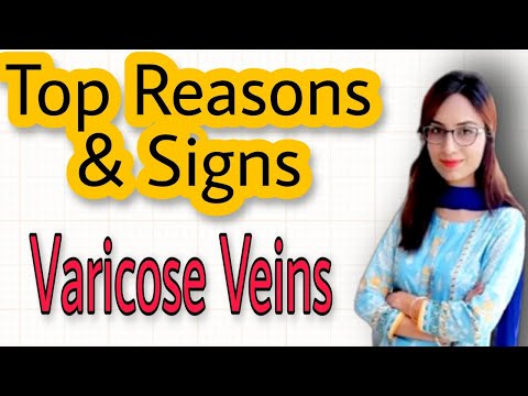 What Causes Varicose Veins? Varicose Veins Signs(Urdu/Hindi)