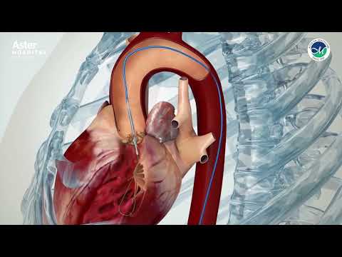Transforming Heart Health with TAVI, Dr Naveed Ahmed | Aster Hospital Mankhool
