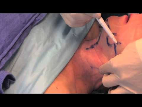 Neck Lift - Dr. Craig Jonov - Lynnwood, WA