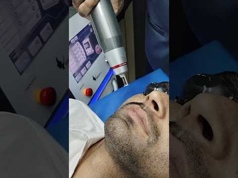 Q-Switch ND YAG Laser for Melasma | Best Laser Treatment for Dark Spots & Pigmentation #melasma