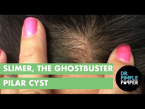 Dr. Pimple Popper Pops Fully-Intact Pilar Cyst On Man's Head