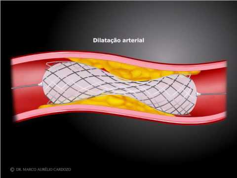 Como é a recuperação após a angioplastia com stent - Tua Saúde