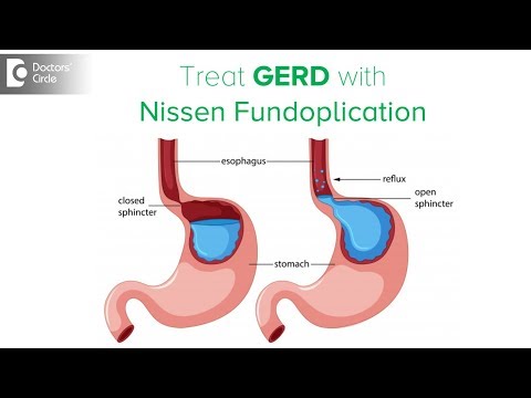 Laparoscopic anti-reflux surgery (Niesen fundoplication) for treatment ...