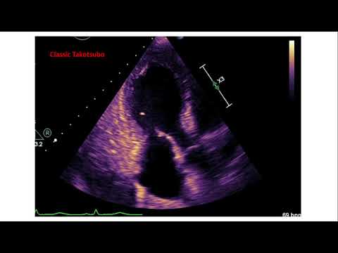 Takotsubo Cardiomyopathy (broken heart syndrome)