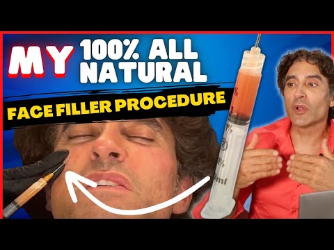 WATCH MY 100% ALL NATURAL FACE FILLER PROCEDURE // Dr Rajani Gets Full Face EZ GEL // PLASMAFIL