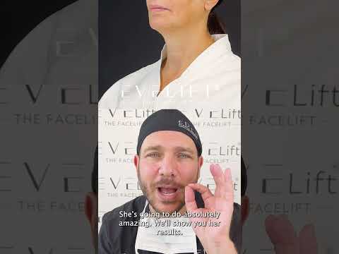 60-Year-Old Patient Before and 24 Hours After EVE Lift™ | Dr. Ali Charafeddine, MD