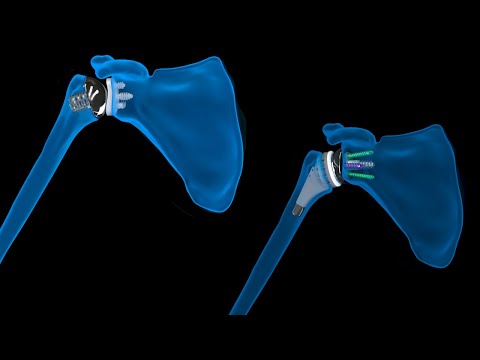 Eclipse™ Total Shoulder System: Ease of Revision