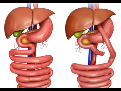 Anastomosis of biliary ducts and gastrointestinal tract CPT code - simplify medical coding