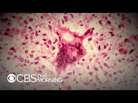 Measles outbreak: What you need to know before flying