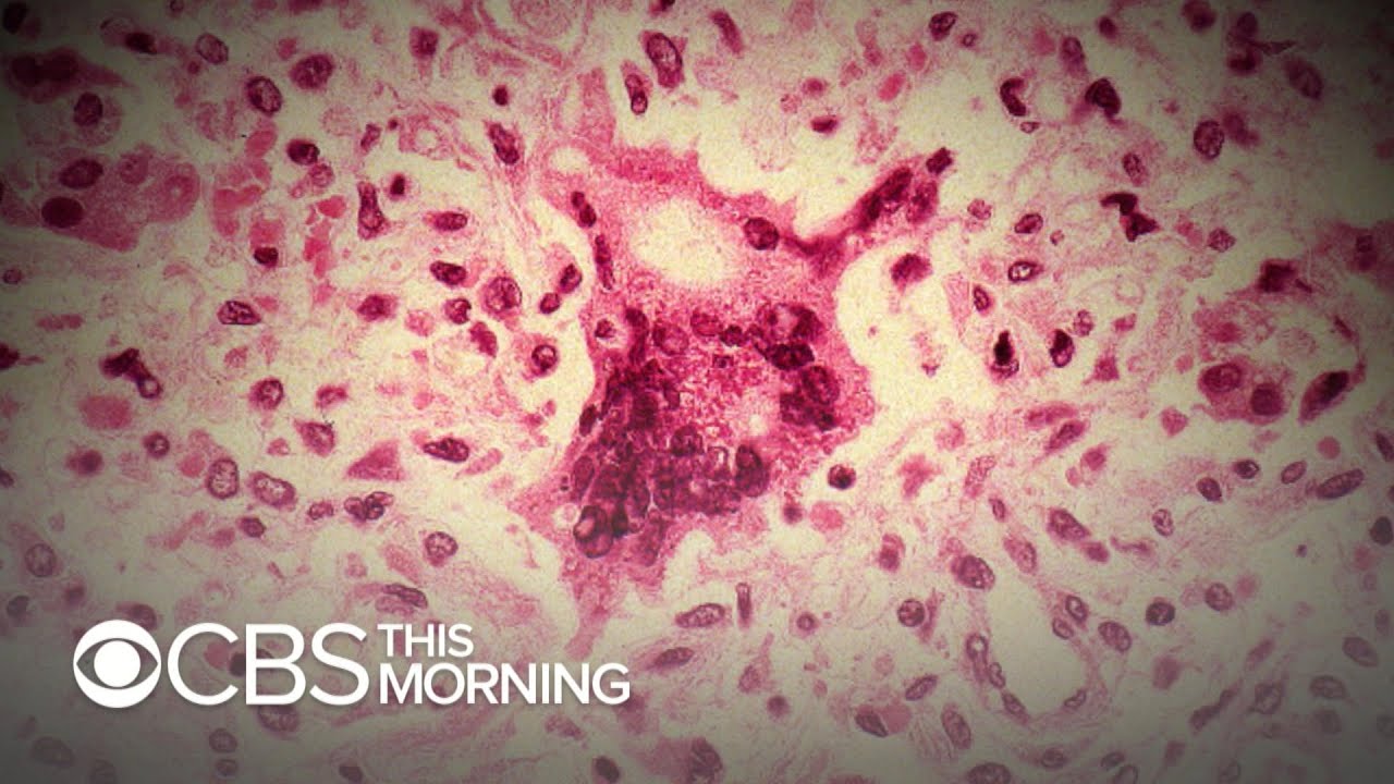 Measles outbreak: What you need to know before flying