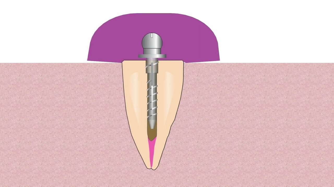 Flexi-Overdenture Animated Technique: Indirect / Coping Procedure