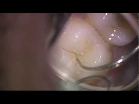 Problem with Sealants