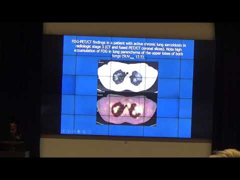 Dr. Ravi Nayak - Sarcoidosis Overview