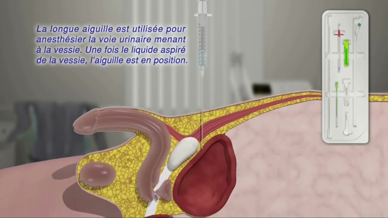 Technique de pose d'un catheter sus pubien