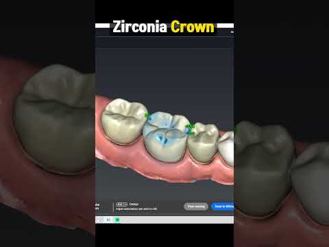 Zirconia Crown Procedure Explained : Pros and Cons in 1 minute