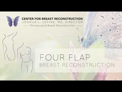 Four Flap Breast Reconstruction - Guided Illustration - By Dr. Joshua L. Levine