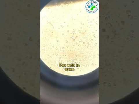 Pus cells in urine | urine microscopic examination | urine microscope #medicallaboratory