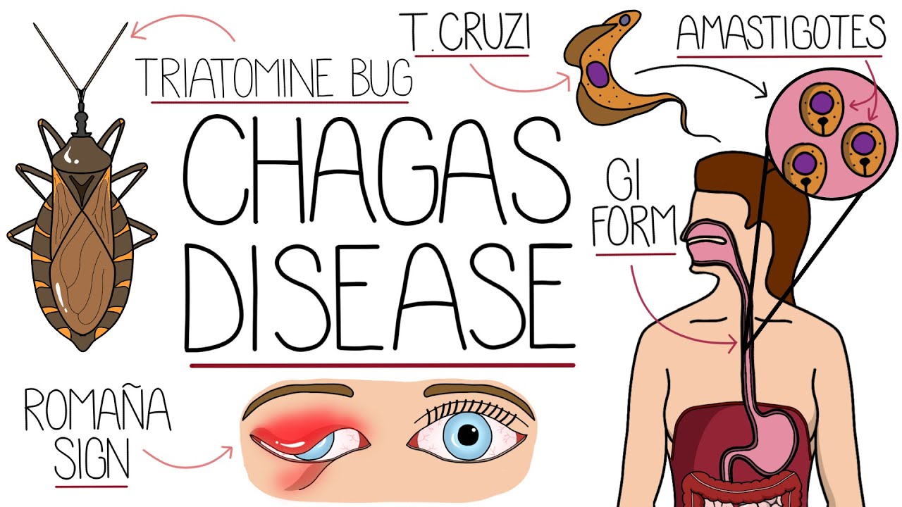 Chagas Disease Explained Clearly (American Trypanosomiasis)