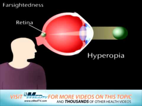 E. Farsightedness | physics project