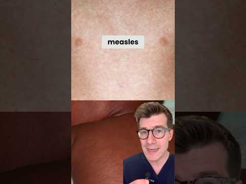 Measles outbreak: symptoms explained #shorts #health