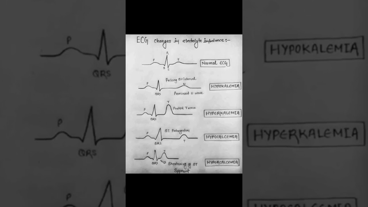 ECG changes