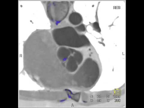 Cardiac: Dilated aortic root and sinuses of Valsalva (10 of 10)