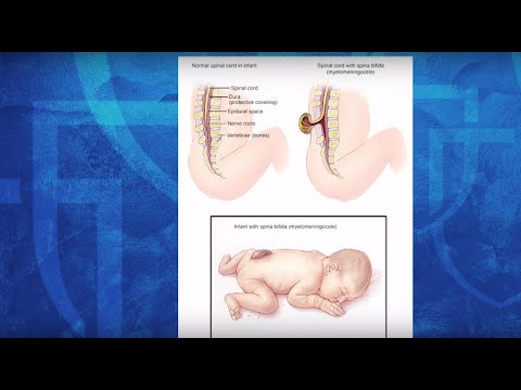 #AsktheMayoMom about Fetal Surgery for Spina Bifida
