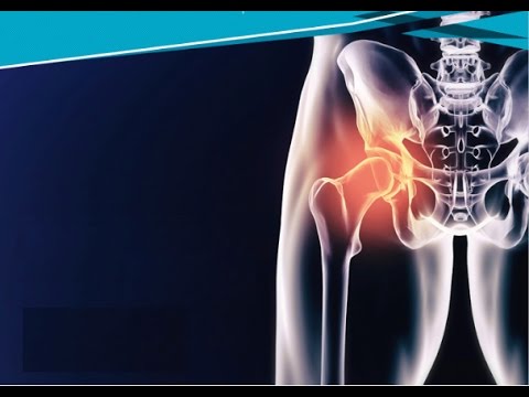 Femoroacetabular Impingement Current Concepts & Treatments