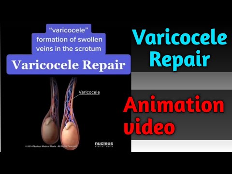 #Varicocele Repair #Animation video