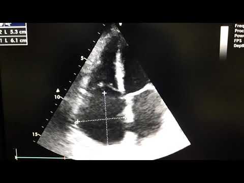 What is the mechanism of TR in this patient?