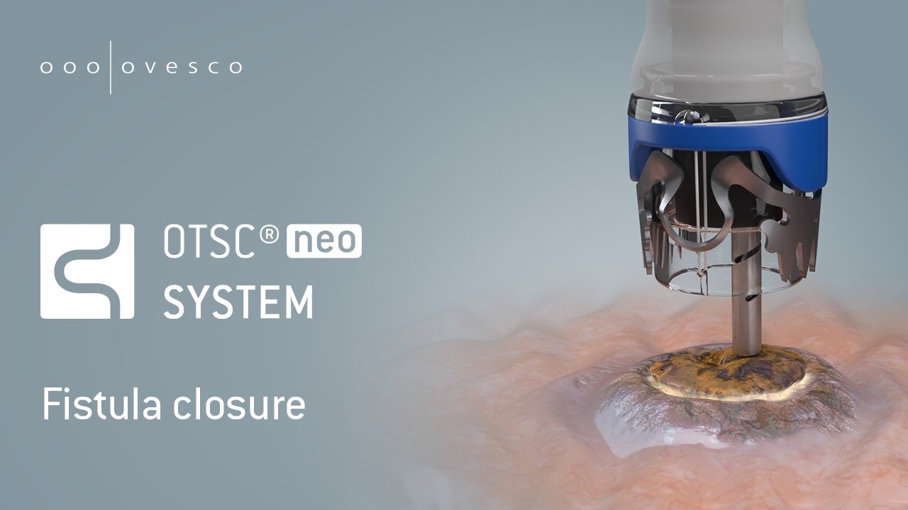 OTSC®neo | Fistula closure