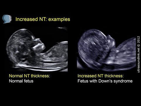 What is significance of increase NT in early pregnancy