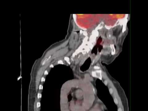 PET/CT Scan Diagnostic Radiology Mercy Medical Center Canton Ohio cantonmercy.org