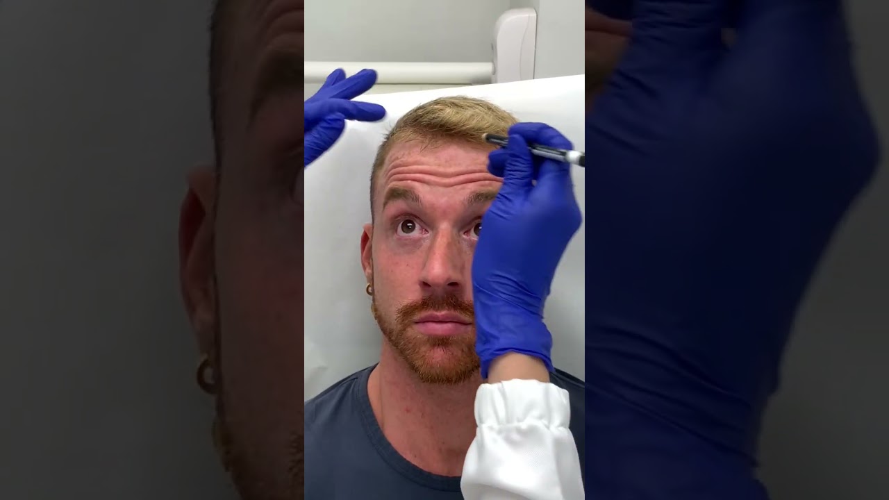 Forehead Furrows, Frown Lines, Crows Feet Botox | Toronto Cosmetic and Advanced Laser Clinic