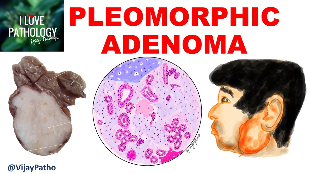 PLEOMORPHIC ADENOMA: Etiopathogenesis,  Clinical features, Gross and Microscopic features.
