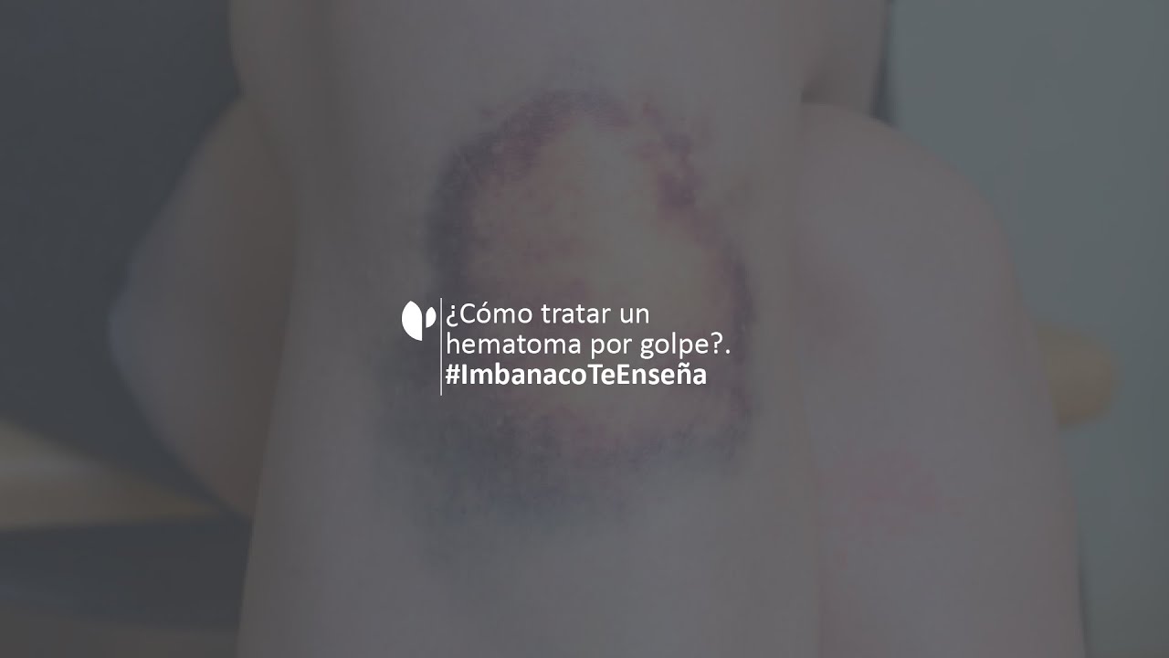 Complete guide to treating a bruise from a blow | Tips from Dr. Alex Estrada of Clínica Imbanaco