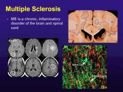 Multiple Sclerosis