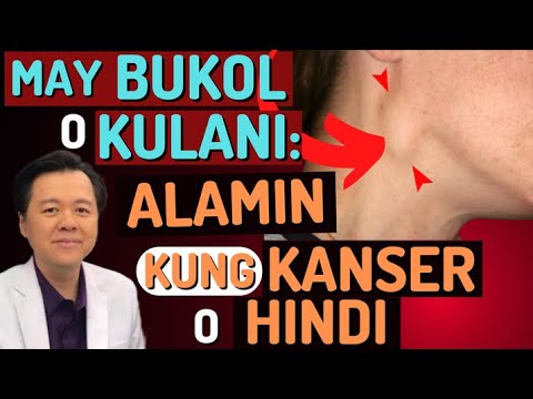 May Bukol o Kulani: Alamin Kung Kanser o Hindi.- by Doc Willie Ong (Internist and Cardiologist)