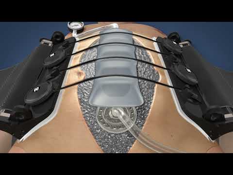 AbClo, Abdominal Closure Device, Instructions for Use