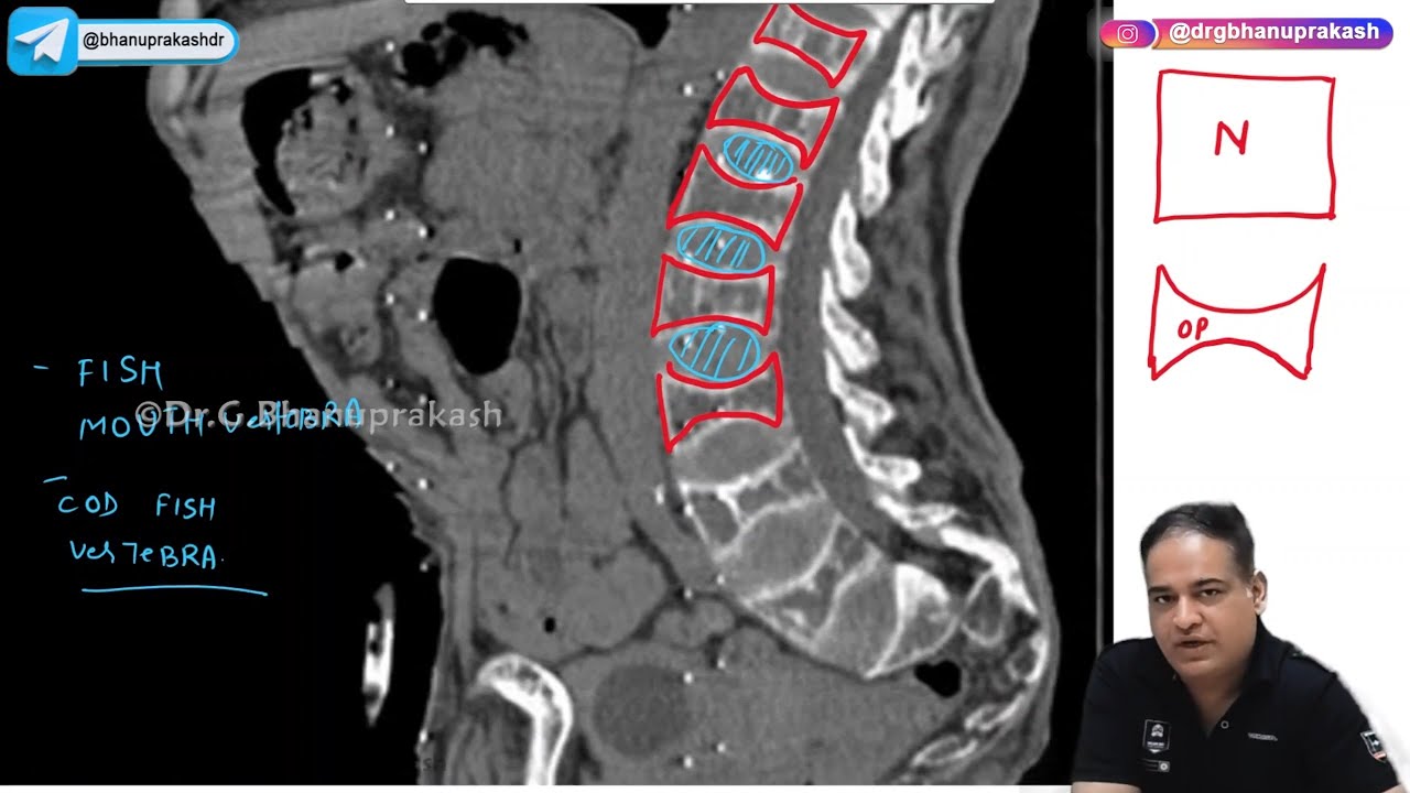Osteoporosis - Causes, Signs and Symptoms, Diagnosis, Treatment, : Orthopedic Lectures 🦴💪🥛