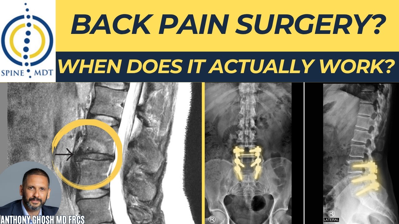 When does surgery for back pain actually work?